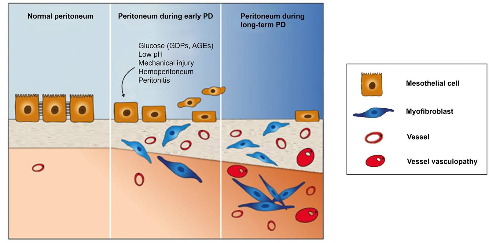 Peritoneal Fibrosis Disease Models - Creative Diagnostics